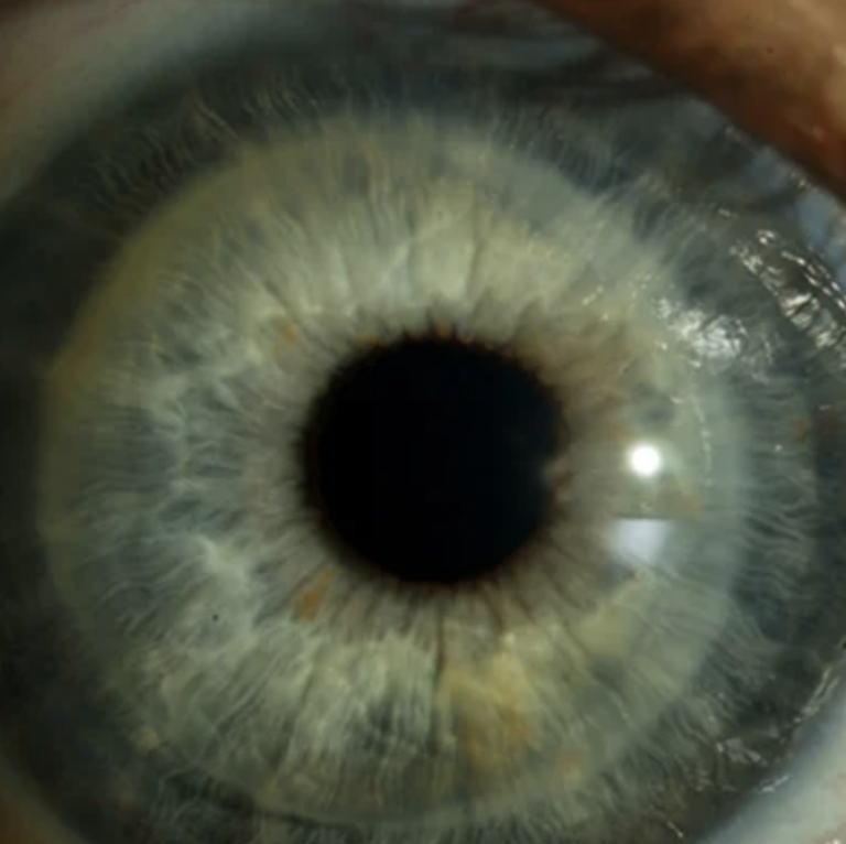 Endothelial Transplantation (DSEK and DMEK) – Lake Austin Eye